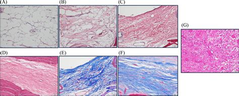 Classification Of Bone Marrow Fibrosis Silver Impregnation Staining Of Download Scientific