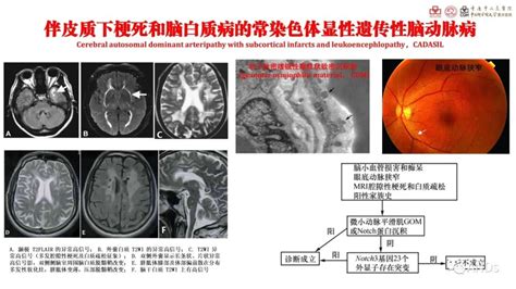 腔隙性脑梗死 Lacunar Infarction腔隙性脑梗死影像学病理学血管直径 健康界