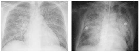 Cardiogenic Pulmonary Edema X Ray