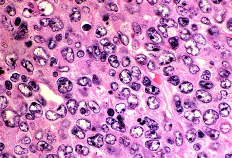 Lymphoma Large Cell Follicular Histiocytic Lymphoma Nodular Lymphoma Histiocytic Nodular