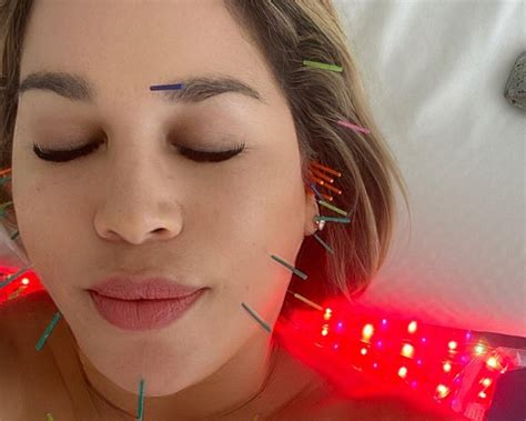 How This Acupuncture Treatment Can Help Recontour Your Face Newbeauty
