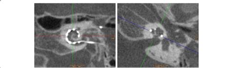 Postoperative Evaluation Of Cochlear Implant Location Using Multiplanar Download Scientific