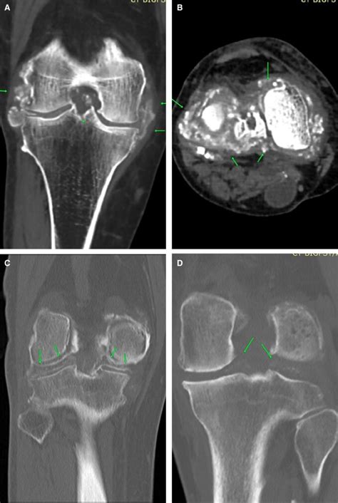 The Ct Knee Arthrogram Revisited Pmc