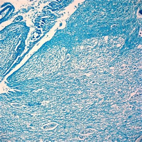 Luxol Fast Blue Lfb Stain Showing Subpial Vacuolar Degeneration And Download Scientific