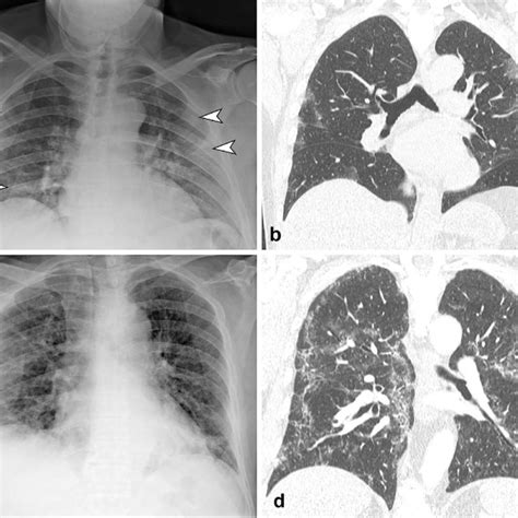 A Cxr In Antero Posterior View Shows Bilateral Reticular Pattern With