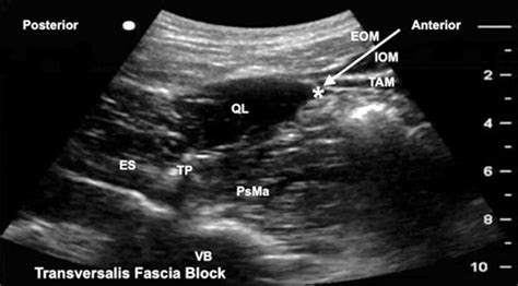 B49 Use Of Ultrasound Guided Quadratus Lumborum Ql Blocks Fulfils ‘dream” “prospect” Post