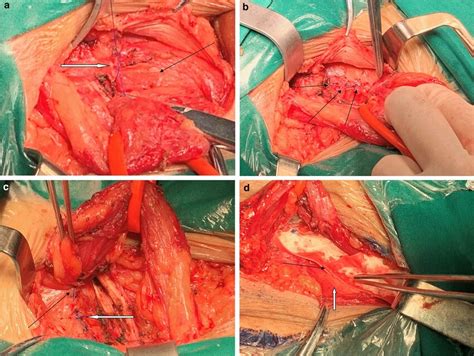 A Suture With Prolene Started From Pubic Tubercle White Arrow First