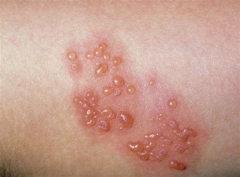 秋天易发带状疱疹？怎么预防带状疱疹？做好这四件事 知乎