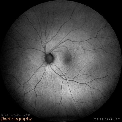 Type 3 Macular Neovascularization Retinography