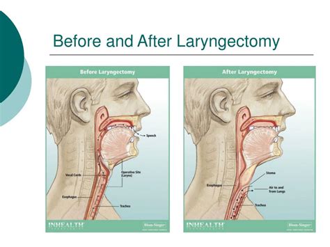Ppt Tracheoesophageal Puncture Voice Prosthesis Tep Vp And Speaking Valves Powerpoint