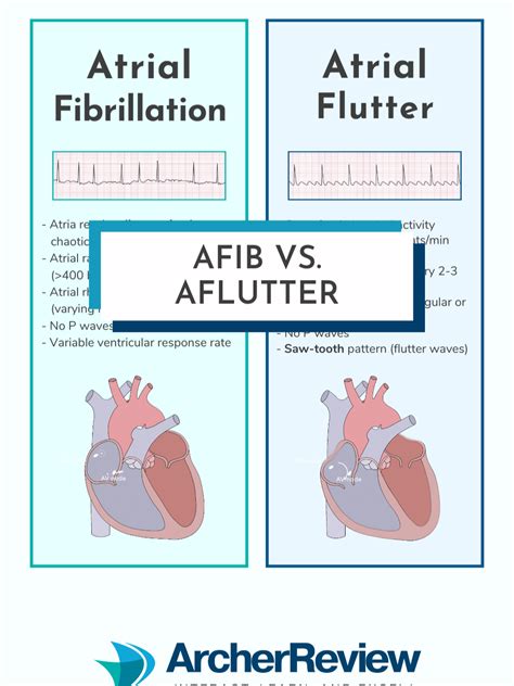 Atrial Fibrillation Vs Atrial Flutter Atrial Flutter Vs Atrial