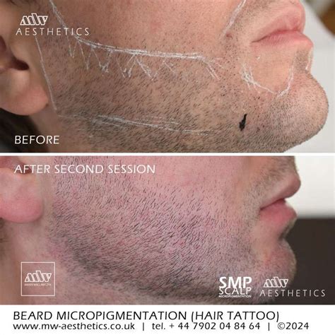 Beard Micropigmentation 2 Mw Aesthetics