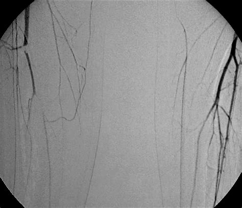 Angiogram Showing A Filling Defect In The Tibioperoneal Trunk And Also Download Scientific