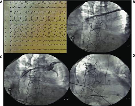 A Basal Electrocardiogram I Degree Type Ii Atrioventricular Block Download Scientific