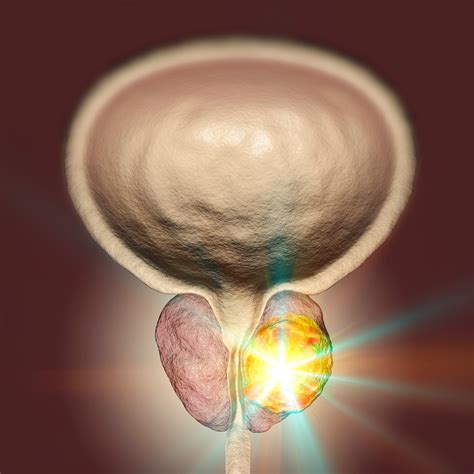 Addition Of Radium 223 To Stereotactic Ablative Radiotherapy In