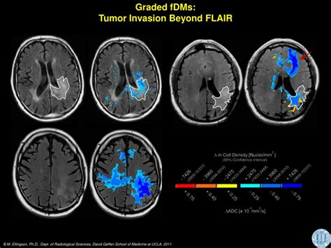 PPT Functional Diffusion Maps FDMs For Brain Tumor Treatment Response Monitoring PowerPoint