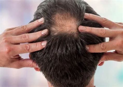 10 Best Haircuts For Balding Crown And How To Treat Bald Spots Hair