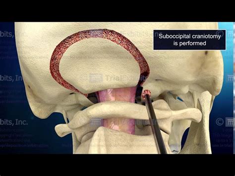 Chiari Decompression