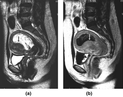 Transient Uterine Myometrial Contraction Associated With Moles