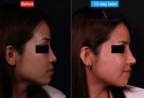 Asian Rhinoplasty Surgery Healing Process Best Surgeon Price
