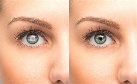 Nuclear Sclerotic Cataract Signs Causes Treatment Options