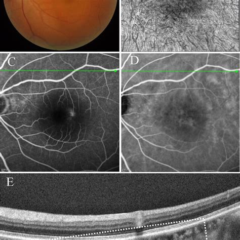 Ss Oct Showed Choroidal Vessels And Choroidal Caverns Without A And Download Scientific
