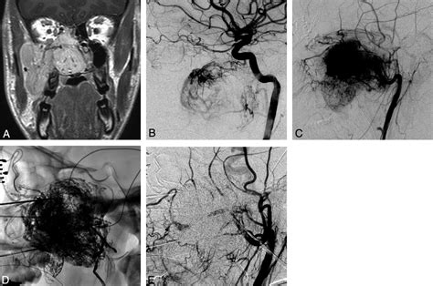 Nasopharyngeal Angiofibroma Juvenile Nasopharyngeal Angiofibroma Jna