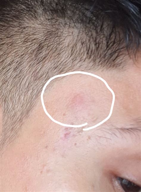 My Pimple Starts Like A Swollen Mosquito Bite How Do I Treat This