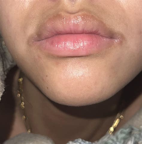 Angular Cheilitis R Skin