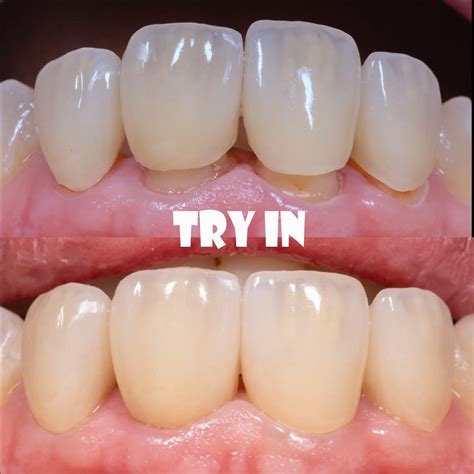 To Splint Or Not To Splint When Brain Gears Work More Than Neurotransmitters Myzerodonto