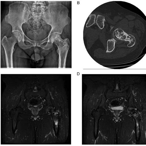 Imaging Manifestations Of Aneurysmal Bone Cyst After Malignant