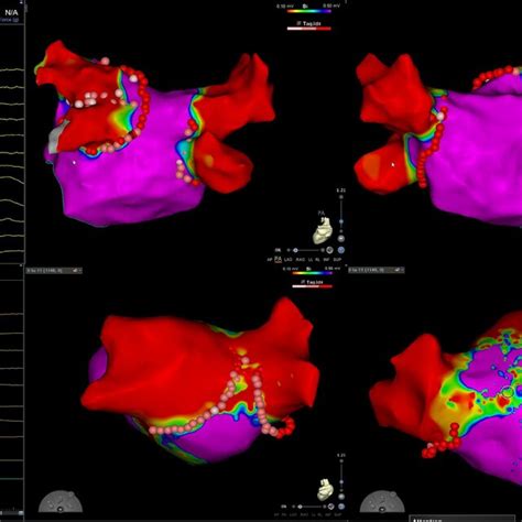 Ptfv1 Analysis And Low Voltage Substrate Mapping In Two Representative Download Scientific