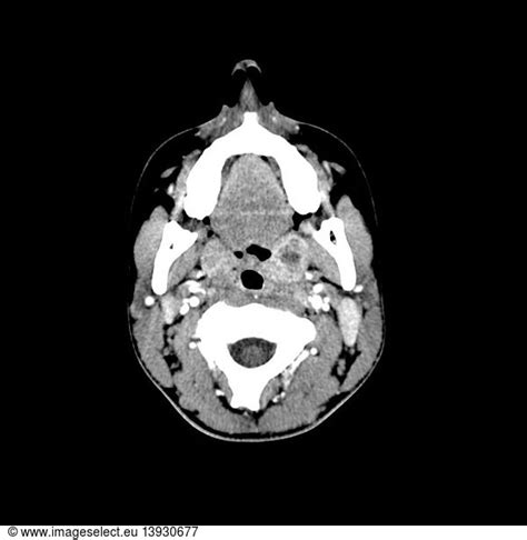 Ct Of Tonsillar Abscess Ct Of Tonsillar Abscessabnormal Ct Neck