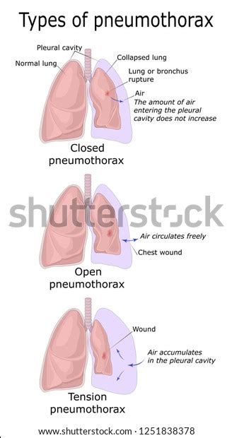 Pneumothorax Types Photos Images Pictures Shutterstock