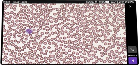 Mid Cells In Cbc
