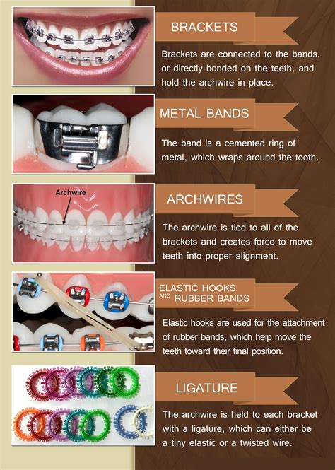 Different Wire Sizes For Braces At Matthew Amundsen Blog