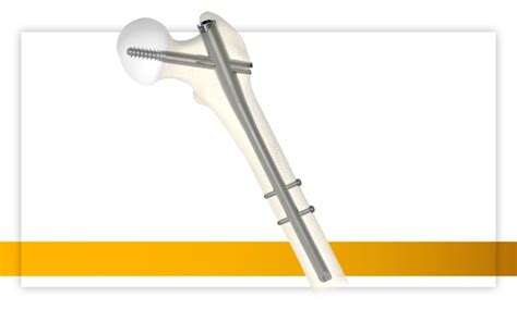 Stryker Introduces New Hip Hardware Techcentury