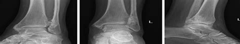 Arthrodesis Of The Distal Tibiofibular Joint A Review Of Th Techniques In Foot And Ankle Surgery