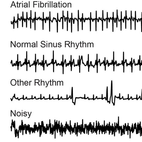 pdf towards understanding ecg rhythm classification using