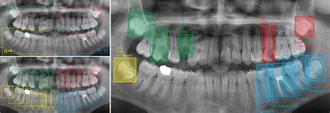 Abnormal Panoramic Dental X Ray