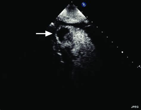 Preprocedural 2 Dimensional Echocardiogram With Contrast Continues To