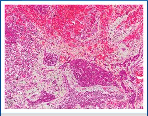 Figure 2 From Intraventricular Choroid Plexus Cavernoma Resection Using