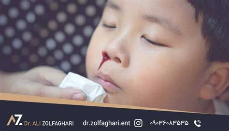 جسم خارجی در بینی کودکان