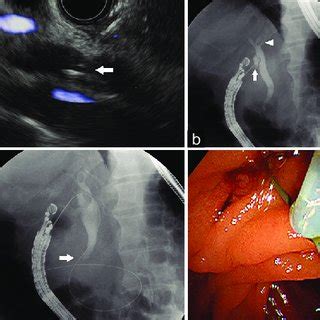 A Case Of Failed ERCP For Carcinoma Of The Duodenal Papilla A Download Scientific Diagram