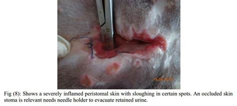 Tube Cystostomy Vs Bladder Marsupialization Clinical And