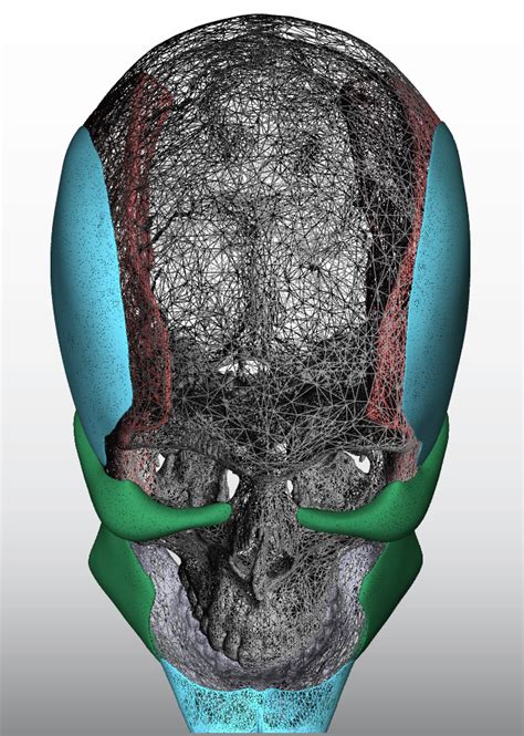 Custom Temporal Implants 3d Design Top View Dr Barry Eppley