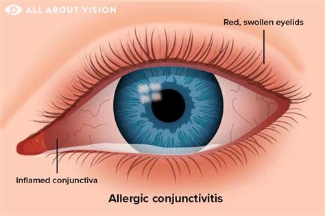 Ocular Conjunctiva