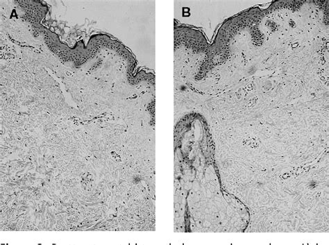 Figure 3 From Treatment Of Widespread Segmental Nevus Spilus By Q‐switched Alexandrite Laser
