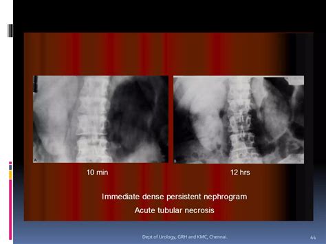 Intravenous Urography 1 Pdf