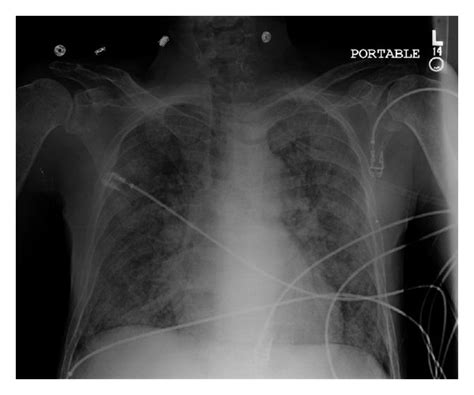 Chest X Ray Ap View Showing Reticulonodular Infiltrates And Download Scientific Diagram